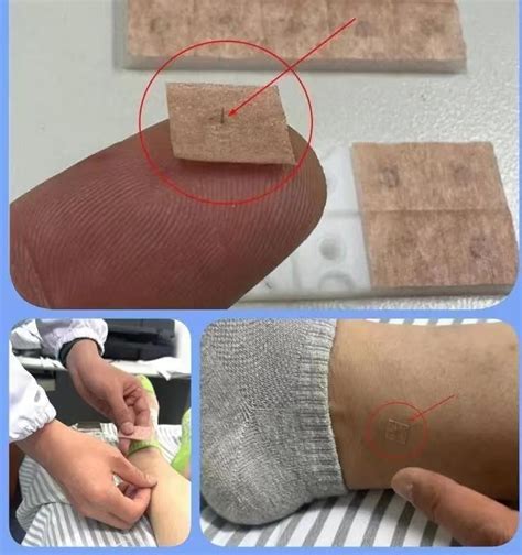 新型中医揿针（皮内针）疗法的操作步骤 知乎