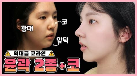 코성형vlog 여자친구 예린과 1초 신세경이 보이는👏 수민이의 후기 인터뷰💕코성형후기 코성형전후 윤곽수술후기 신세경코 더옙tv Youtube