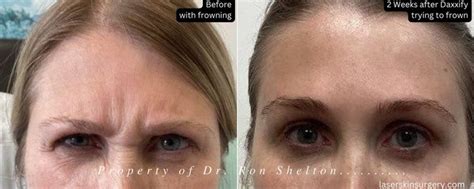 Nyc Daxxify Before And After Ron Shelton M D Patient Photos