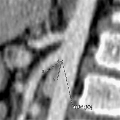 Pdf Nutcracker And Sma Syndromes What Is The Normal Sma Angle In