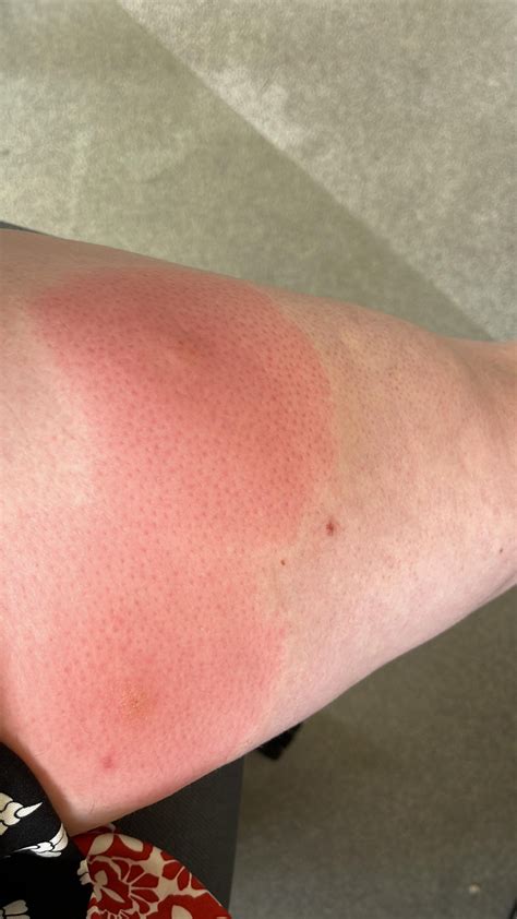 Bug Bite Does This Look Like Cellulitis R Dermatologyquestions