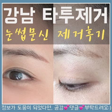 강남 눈썹문신제거 하고 문신제거비용 찐후기 네이버 블로그