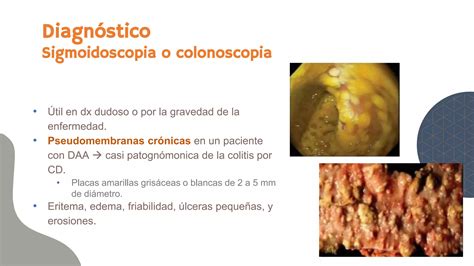 Colitis Pseudomembranosa Pptx