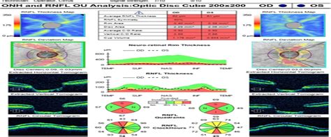 A Case Of Uveitis Glaucoma Hyphema Syndrome Related To A Hyd Journal Of Glaucoma