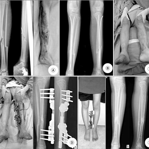 A A 15 Year Old Female Sustained Open Fracture Of The Tibia And Download Scientific Diagram