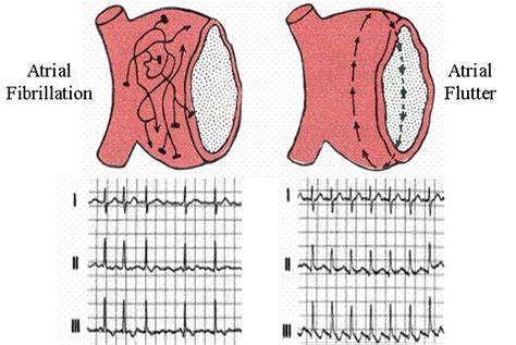 Flutter Atriale 1 Test Ammissione