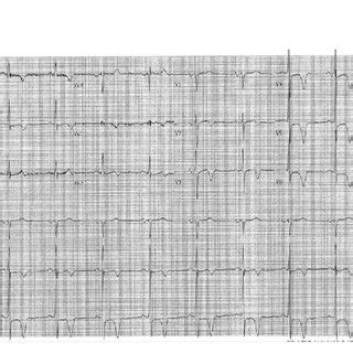 Diffuse Deep T Wave Inversion In Anterolateral Leads L1 AVL V2 V6 Download Scientific