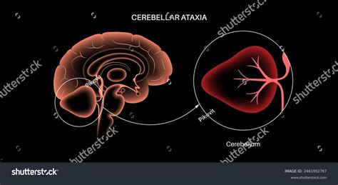 Sensory Ataxia Over 98 Royalty Free Licensable Stock Illustrations And Drawings Shutterstock