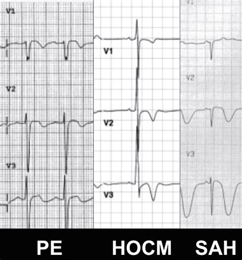 T Wave Inversion In Anterior Leads REBEL EM Emergency Medicine Blog