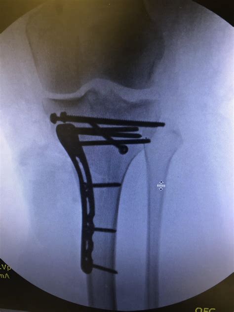 Nine Screws Later And They Got My Tibia Back Together R XRayPorn