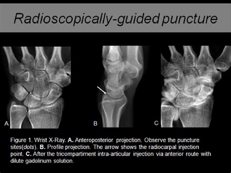 Figure 1 From Arthro Mri Findings On Tfcc Lesions And Intrinsic Ligaments Of The Wrist