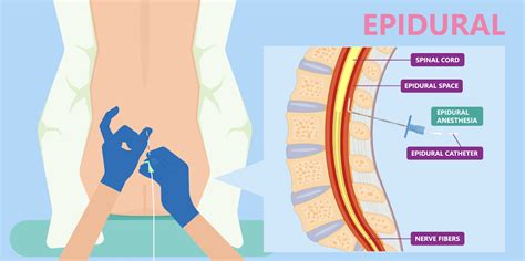 How Do Epidurals Work And Why Is There A Global Shortage Of Them