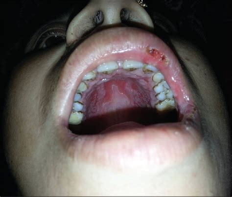 Pyodermatitis Pyostomatitis Vegetans Pmc