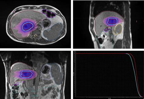 Magnetic Resonanceeguided Stereotactic Ablative Radiation Therapy Plan Download Scientific