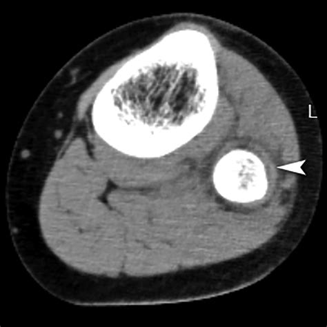 Computed Tomography Scan Of The Proximal Metaphysis Of The Left Fibula