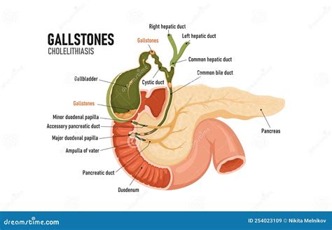 Cholelithiasis Formations In The Gallbladder Blockage Of The Bile