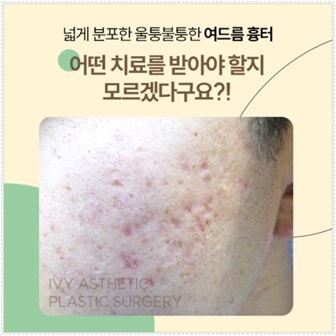 여드름 패인흉터 작은 변수까지 고려한 치료 방법은 네이버 블로그