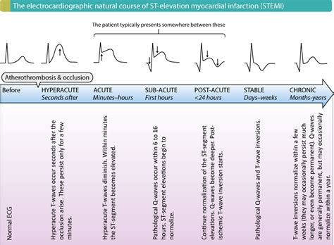 The Ecg In Assessment Of Myocardial Reperfusion The Cardiovascular
