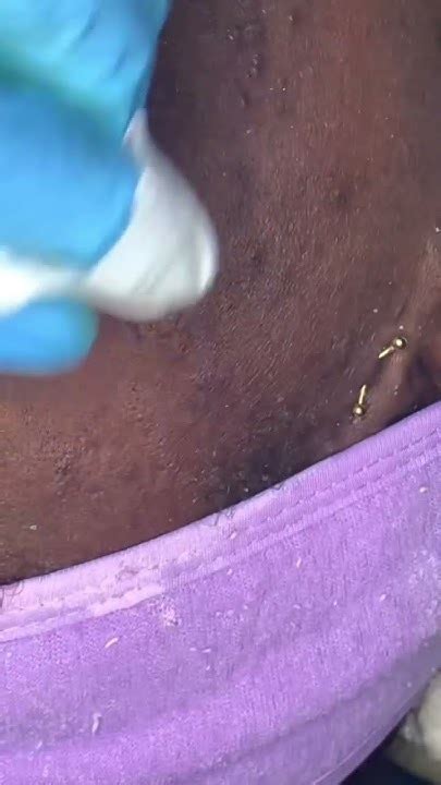 Pimple Popping And Blackhead Removal Blackheads Facial Like Pimplepopping Shorts Subscribe