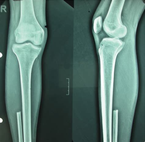 Figure 1 From Chondroblastic Osteosarcoma Of Proximal Fibula Semantic Scholar
