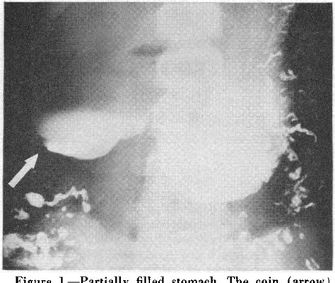 Figure 1 From Partial Duodenal Obstruction Secondary To Annular