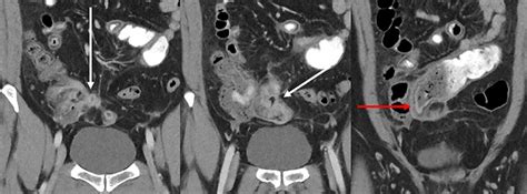37 Year Old Man Who Underwent Primary Ileocolic Resection For Complex Download Scientific