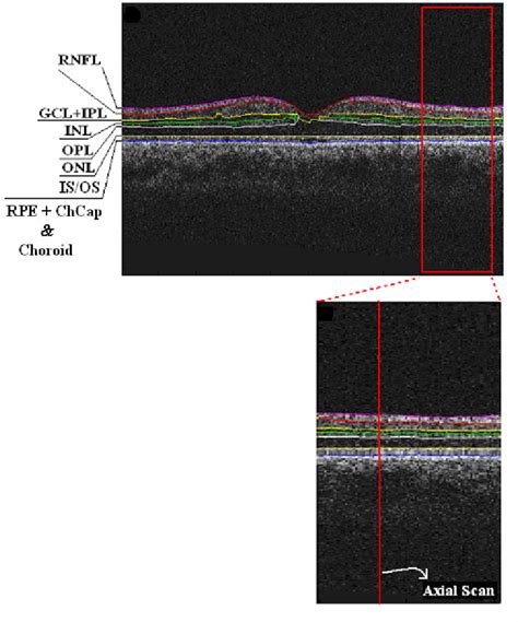 Automated Segmentation Results Top Original Oct Image With Overlaid Download Scientific