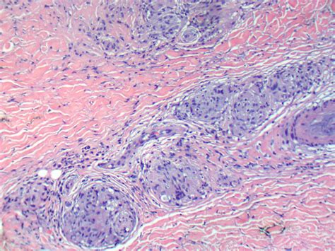 Virtual Grand Rounds In Dermatology 2 0 65 Yo Woman With Nodulo Ulcerative Leg Lesions