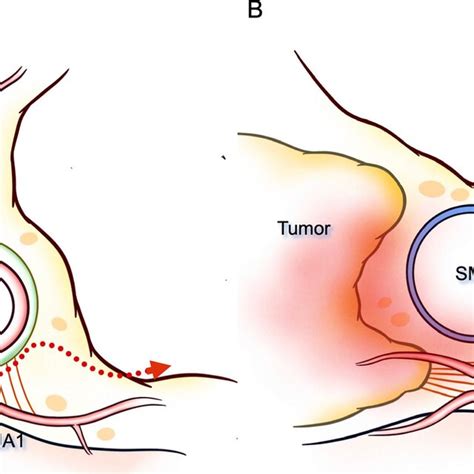 Schematic Representation Of Mesopancreas And Mesocolon Dissection And