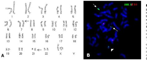 Figure 1 From A Novel Translocation Involving Runx1 And Hoxa Gene