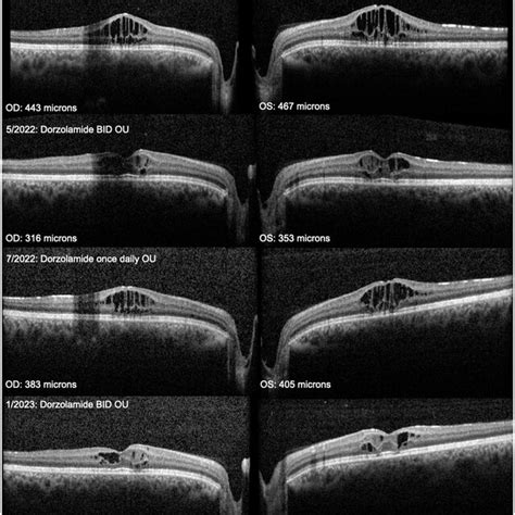 Series Of Oct Horizontal Raster Scans Through The Foveas Of The Right