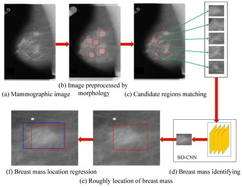 Breast Mass Detection In Mammography Based On Image Template Matching And Cnn
