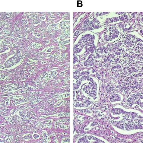 Hande Vermiform Appendix A 4× Exhibits Organoid And Trabeculated Hande Vermiform Appendix A 4× Exhibits Organoid And Trabeculated