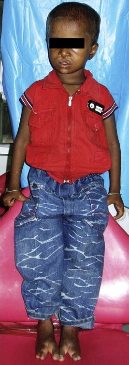 Ectrodactyly Ectodermal Dysplasia Clefting Syndrome Eec Syndrome Pmc