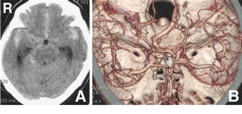 A Computed Tomography Ct Scan Demonstrating Diffuse Thick Download Scientific Diagram