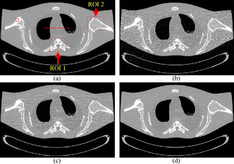 Figure 1 From Iterative Image Reconstruction For Low Dose X Ray Ct Using A Sinogram Restoration