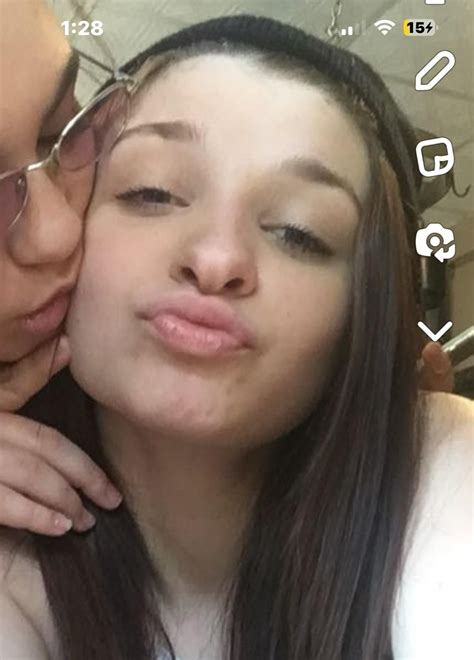 Rhinoplasty Before And After 1 Year Post Op R Plasticsurgery