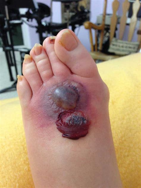 Pyoderma Gangrenosum Nov 25 2012