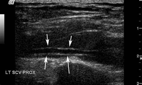 Venous Duplex Upper Lower Extremity Vein Mapping Flashcards Quizlet