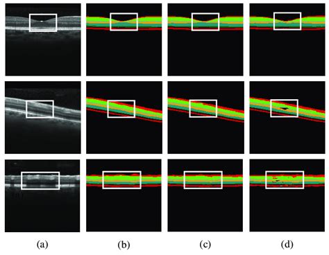 The Segmentation Results Of Oct Images In The Hcms Dataset Column A