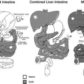 Surgical Anatomy Of Intestinal Transplant Types Including Iit Lit And