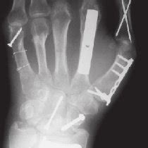 Various Fixation Methods Of Metacarpal Fractures Metacarpal Base Download Scientific Diagram