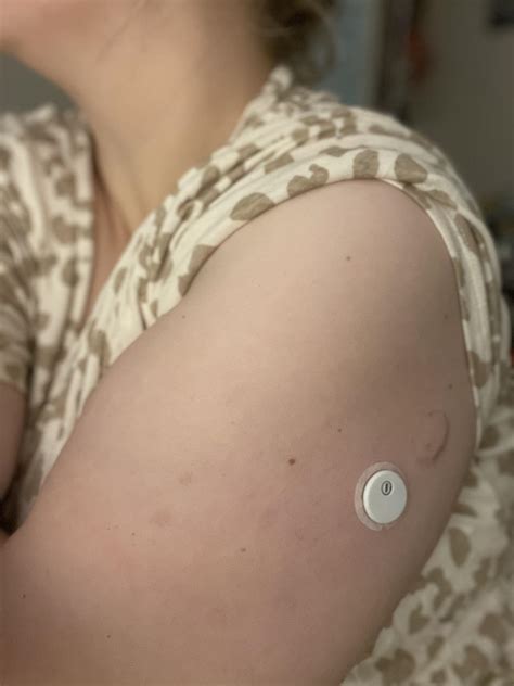 Is My Freestyle Libre Too Far Forward On My Arm R Freestylelibre