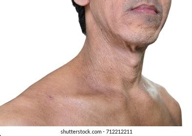 Skin Lesion Crusting Images Stock Photos Vectors Shutterstock