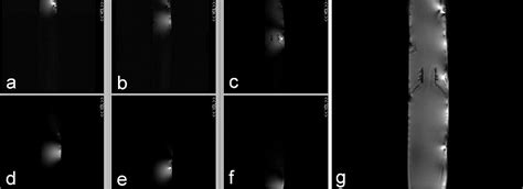 Figure 7 From Ice Decoupling Technique For Rf Coil Array Designs Semantic Scholar