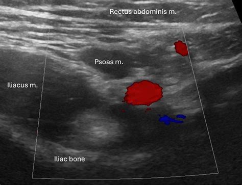 🎓 Cme Opportunity Pediatric Appendicitis Us Practical Considerations 🔗 Bitly3zide8v