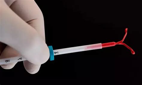 Levonorgestrel Iud Users Report Low Rates Of Hormonal Side Effects