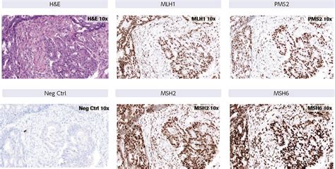 Msi検査 Mmr Ihc検査とは Msi検査 Msd Connect