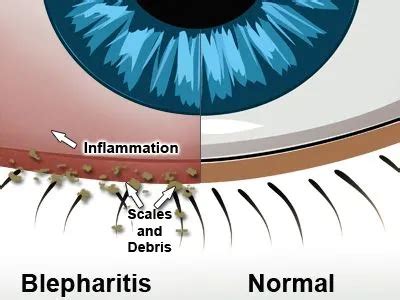Blepharitis Treatment In Elko Total Eyecare