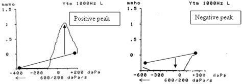 Tympanometry Test Tympanometry Types And Abnormal Tympanometry Results